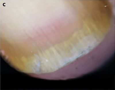 Onychomycosis