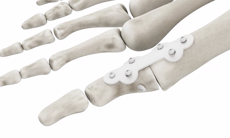 Product Showcase - A New Approach to MTP Joint Pain