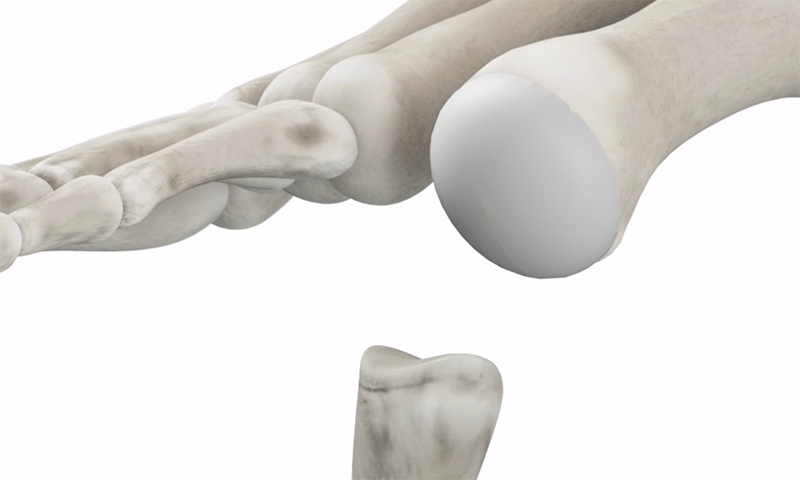 Product Showcase - A New Approach to MTP Joint Pain