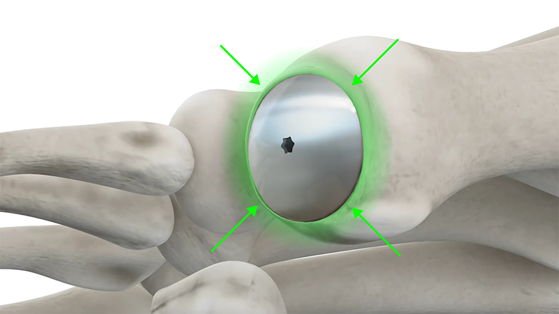 Product Showcase - A New Approach to MTP Joint Pain