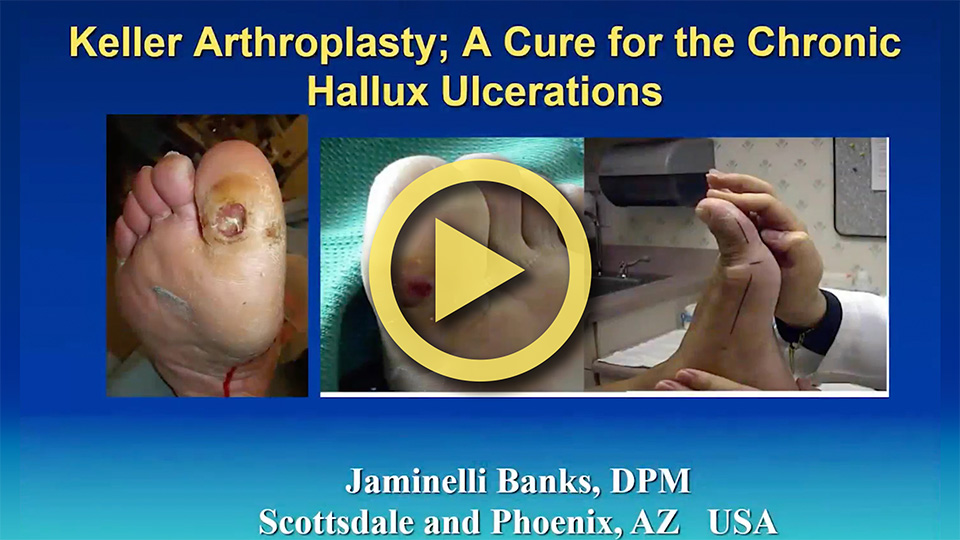 This Just In... - Keller Arthroplasty; A Cure for Chronic Hallux ...