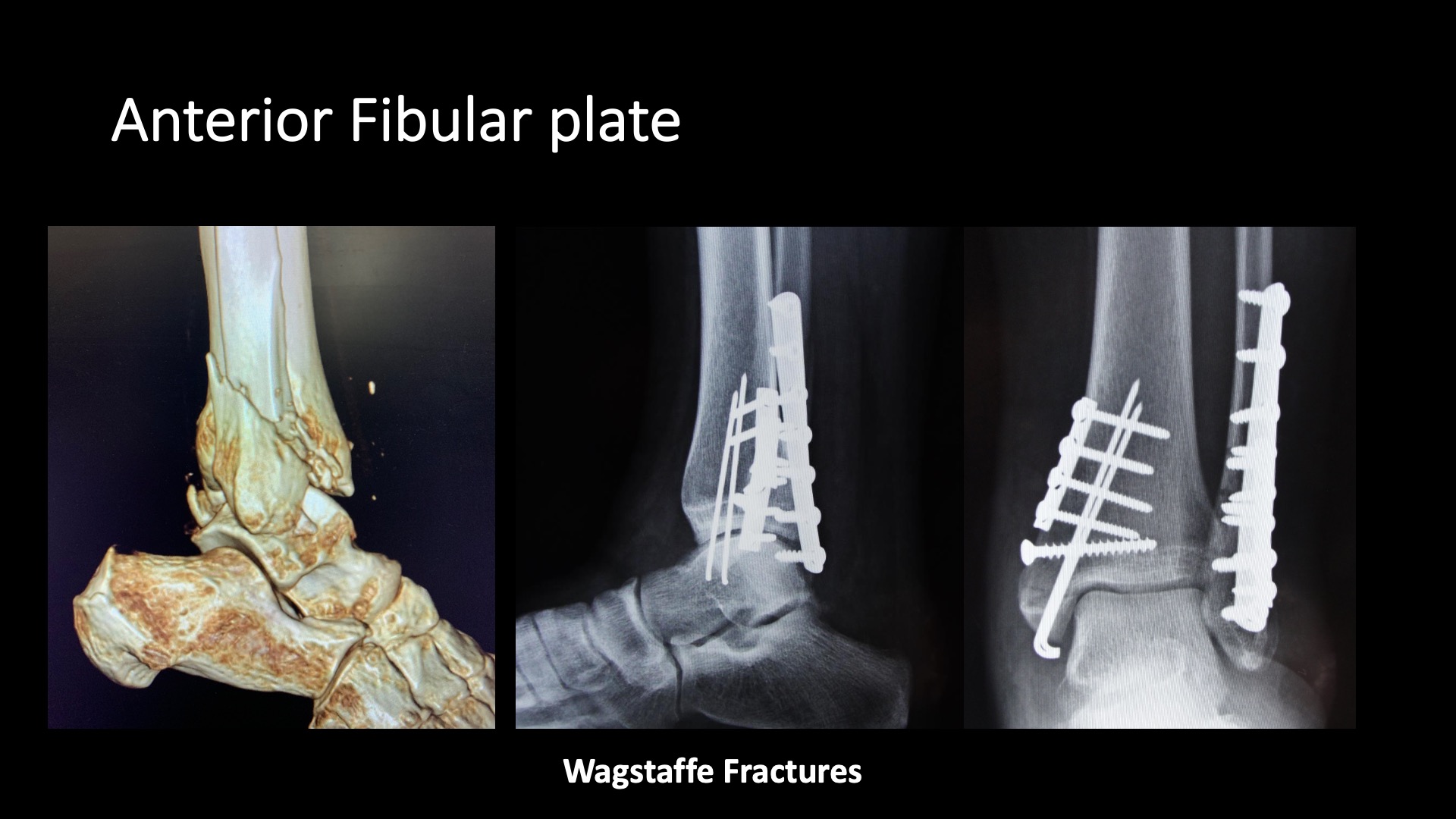 This Just In... Surgical Management of Complex Ankle Fractures