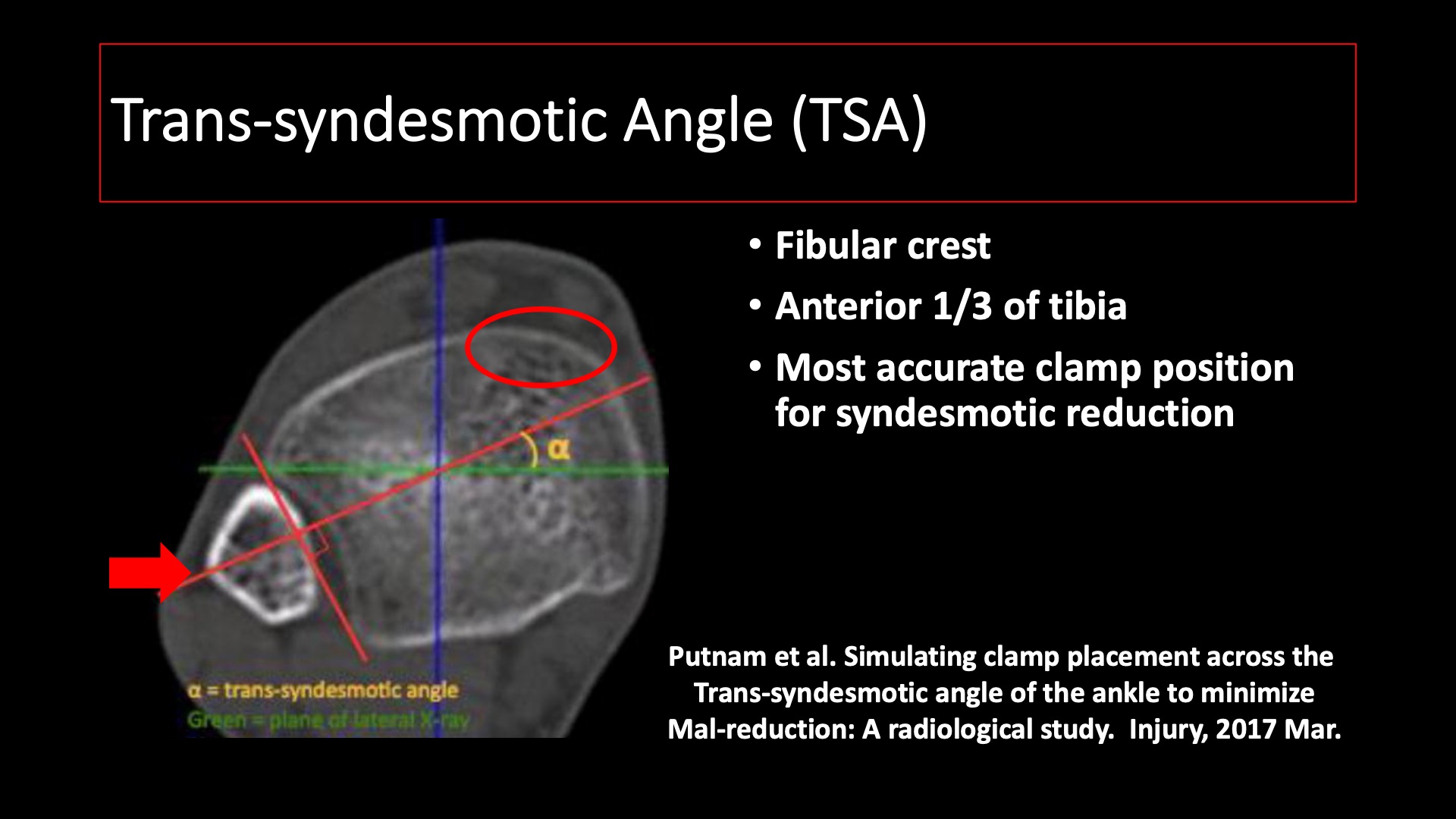 This Just In... Surgical Management of Complex Ankle Fractures