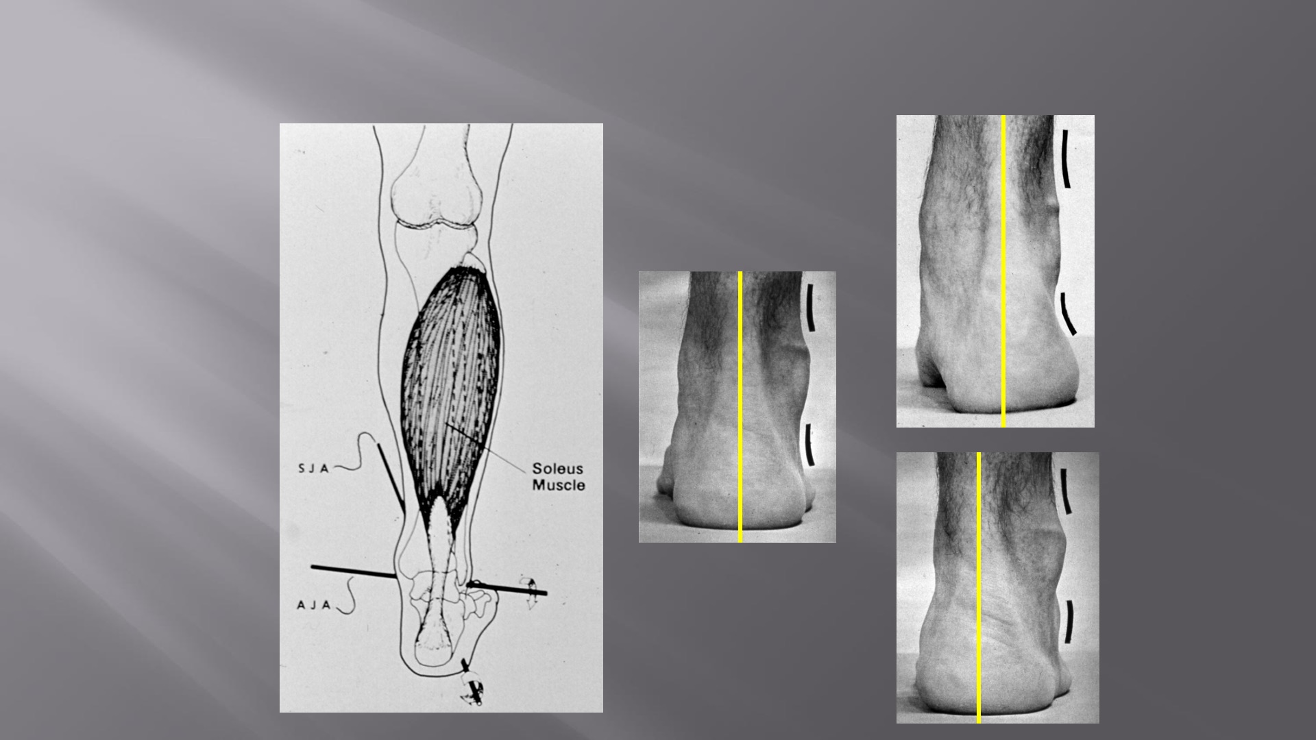 This Just In... - Pathomechanical Basis for Tendon Transfer Part 1