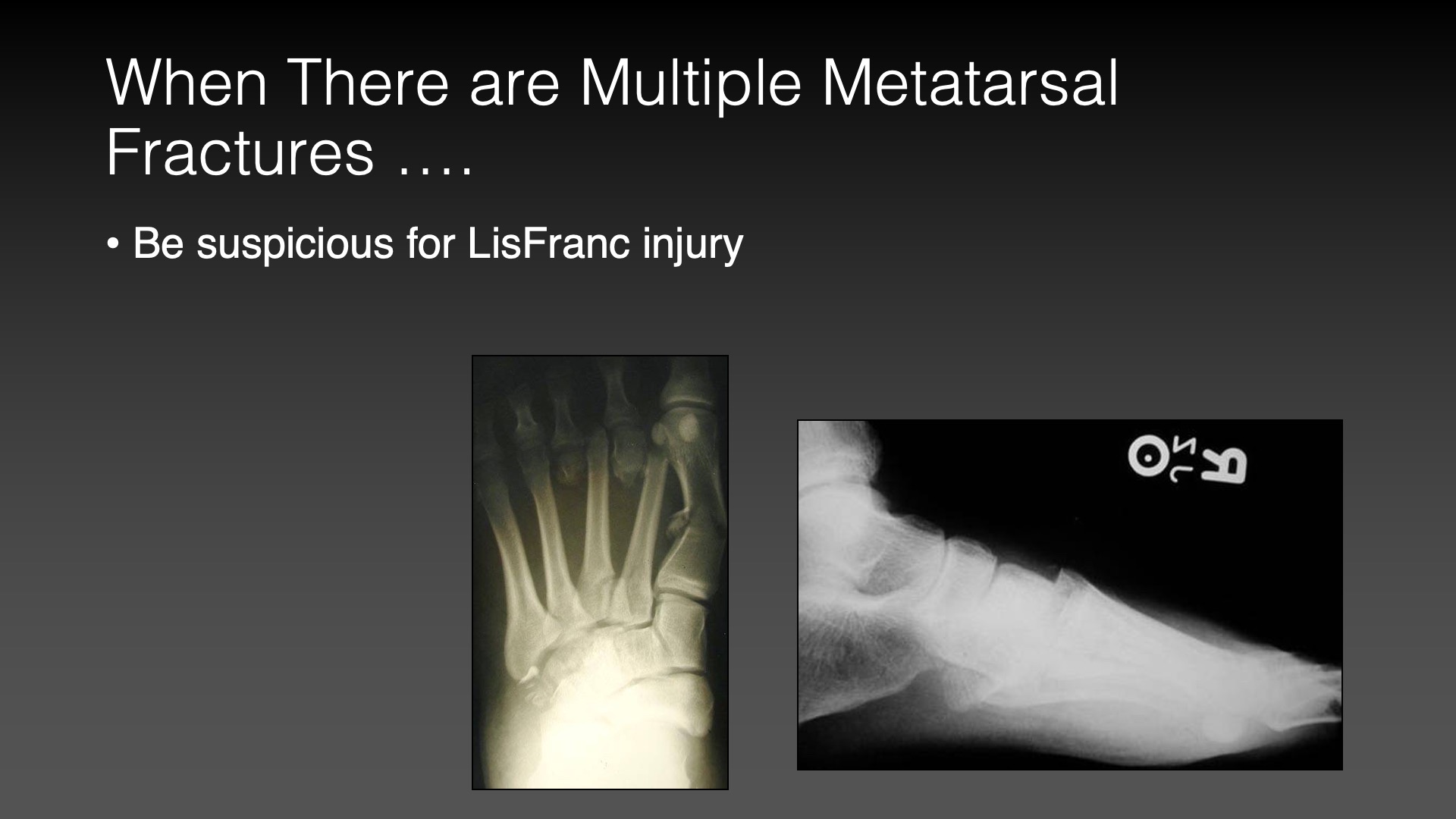 This Just In... - Common Foot Fractures