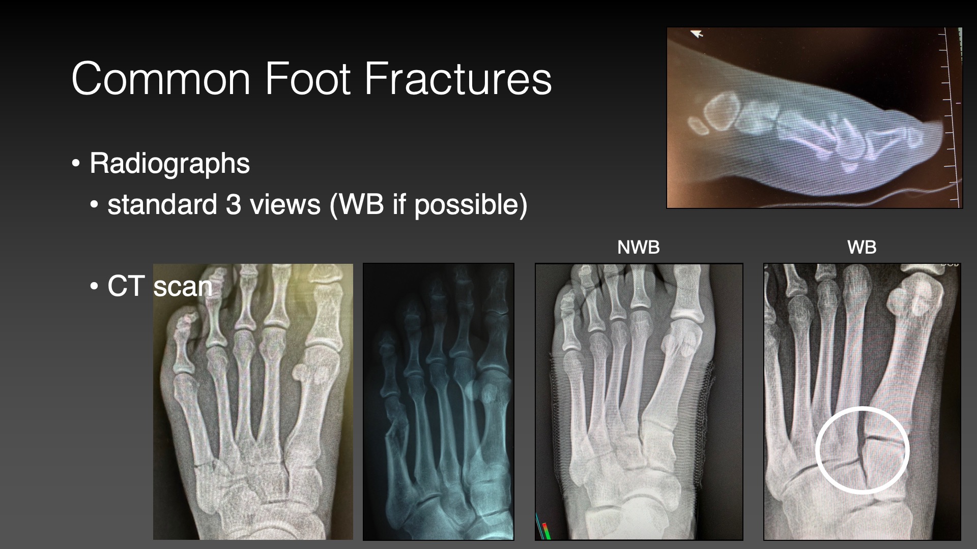 This Just In... - Common Foot Fractures