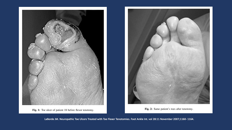 This Just In... - Flexor Tenotomy for the Treatment for Digital Ulcerations