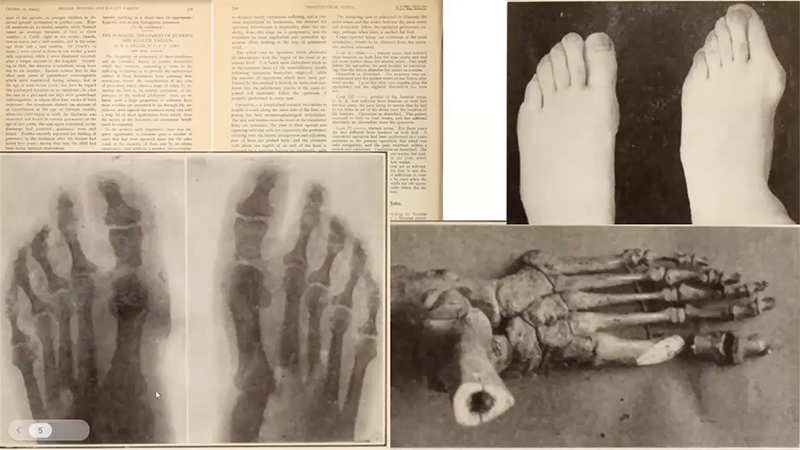 This Just In... - The Keller Bunionectomy for HIPJ Ulcerations