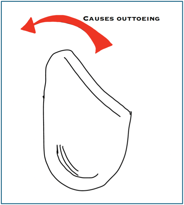 Practice Perfect 951 - Should We Stop Using Gait Plates for Intoeing?